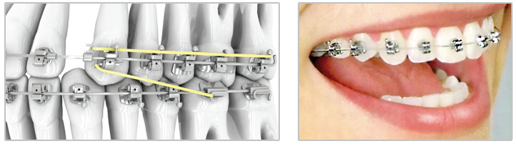 SPEED Brackets - Kevelaer - Dr. Walter & Kollegen